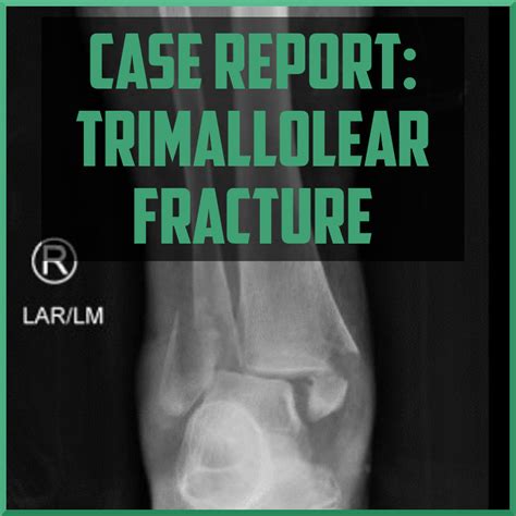 Maisonneuve Fracture Orif