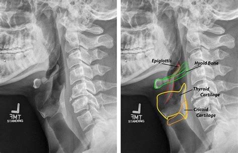 Vocal Cord Polyps Nodules And Granulomas Ear Nose And Throat Disorders