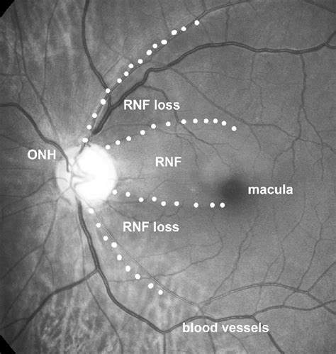 One Image From Our Database Showing Macula Optic Nerve Head Onh Download Scientific Diagram