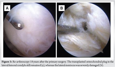 Re Arthroscopic Findings 18 Years After Osteochondral Autologous