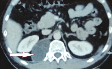 Enhanced Abdominopelvic Computed Tomography Scan Showed A Right Download Scientific Diagram