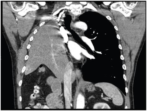 Preoperative Ct Scan Noting Significant Compression Of The Right Atrium