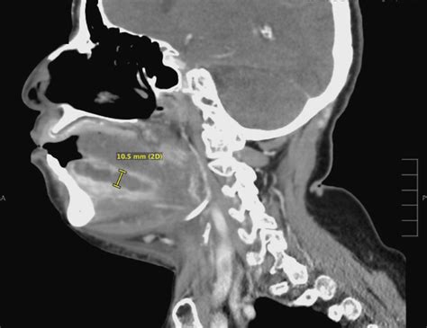 Woman With Facial Swelling Harrington 2023 Journal Of The American College Of Emergency