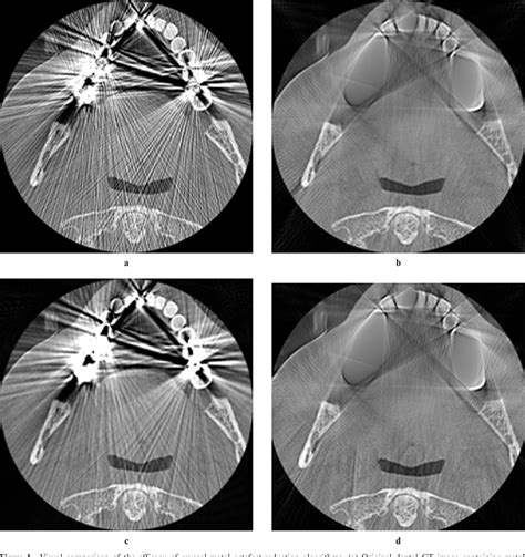 Figure 1 From Dental Ct Metal Artefact Reduction Based On Sequential