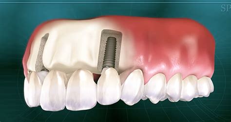 Implant Supported Bridge Keystone Dental Arts