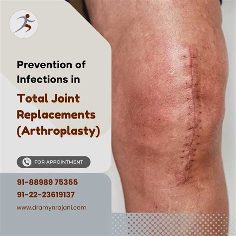 Prevention Of Infections In Total Joint Replacements Arthroplasty