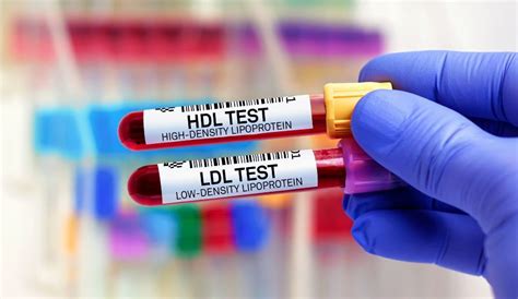 Czym Jest Lipidogram Dowiedz Się Kiedy Warto Wykonać Badanie E