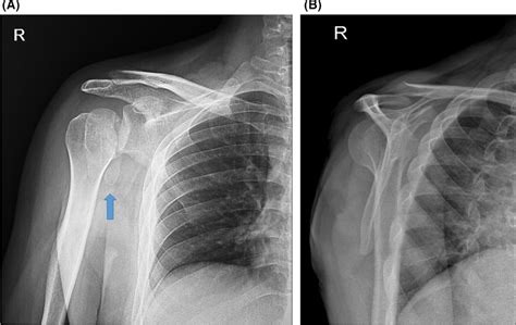 A Ap View Of Right Shoulder Demonstrating Internal Rotation Of