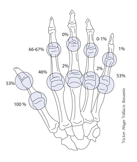The Prevalence Of Distribution Of Sesamoid Bones In The Proximal