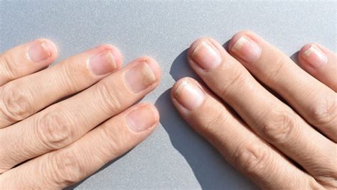 Psoriasis Toenails Treatment
