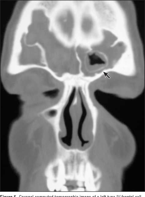 Frontal Sinusitis Semantic Scholar