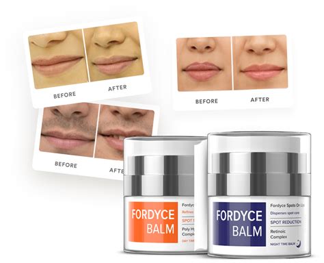 Fordyce Gel Fordyce Spots Removal Home Treatment