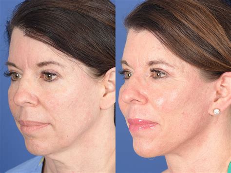 Patient 184337 Cheek Implant Before And After Photos Weber Facial