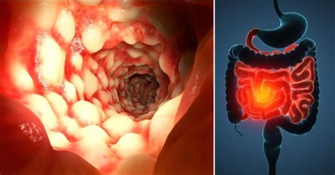 Ulcerative Colitis Meaning Causes Risk Factors Types And Symptoms Healthtian