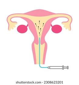 Illustration Artificial Insemination Stock Vector Royalty Free Shutterstock