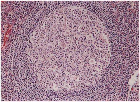 正常淋巴结组织学与免疫功能区 淋巴瘤病理诊断