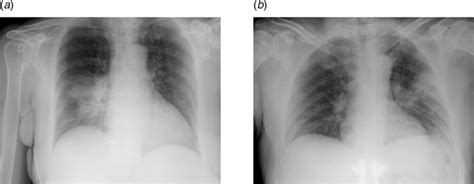 Chest X Rays Showing Bilateral Patchy Infiltrates Of A Patient 1 And