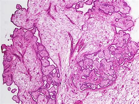 Well Differentiated Papillary Mesothelioma