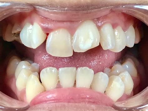 Crowded Teeth Causes Effects And Treatment Options