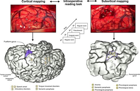 Illustration Of A Cortical And Subcortical Mapping Des Applied During Download Scientific