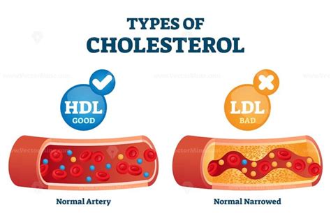 Cholesterol Types Comparison With HDL And LDL Lipoprotein Vector Illustration VectorMine