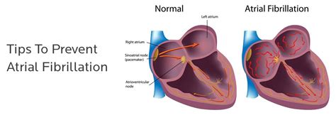 Tips To Prevent Atrial Fibrillation