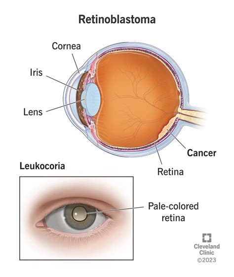 Retinoblastoma Ambisius Wiki