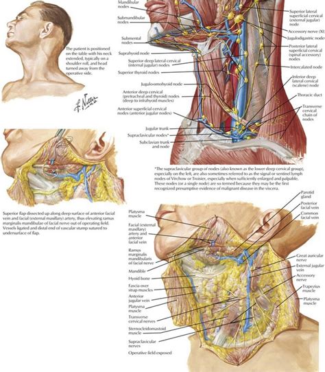 Selective Supraomohyoid Neck Dissection Levels I Iii Basicmedical Key