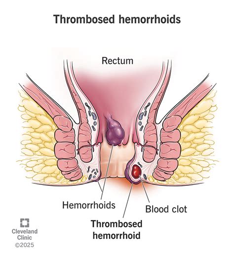 Thrombosed Hemorrhoids Symptoms Causes And Treatment