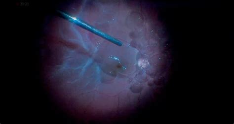 Vitrectomy For Pvr Induced Retinal Detachment With Peripheral