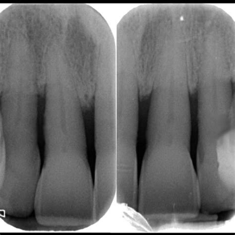 Periapical X‐rays Showing Severe Bone Loss X‐rays Taken At The