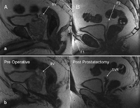 Prostate Mri Anatomy Radiographics Anatomy Structure