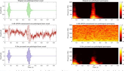 Figure 6 From Robust Denoising Of Phonocardiogram Signals Using Time Frequency Analysis And U