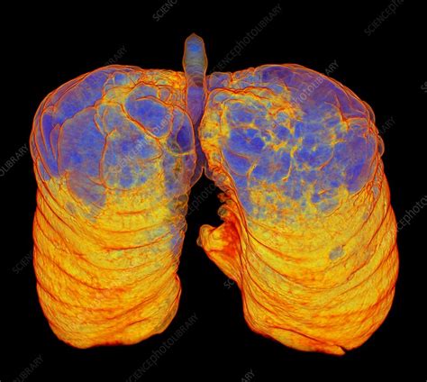 Smokers Lungs And Emphysema 3d Ct Scan Stock Image C0400970