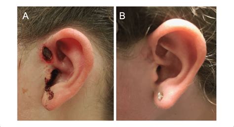 Post Operative Image Of Preauricular Sinus And Healing Of The Sinus Download Scientific Diagram