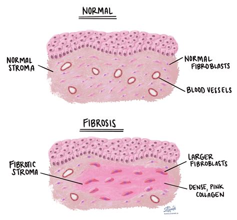 Fibrose Mypathologyreport