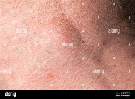 Lipoma In The Neck Of A 68 Year Old Male Patient A Lipoma Is A Benign