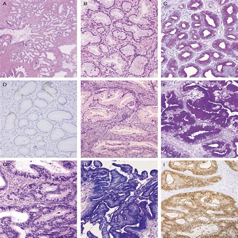 Lobular Endocervical Glandular Hyperplasia Is A Neoplastic E The