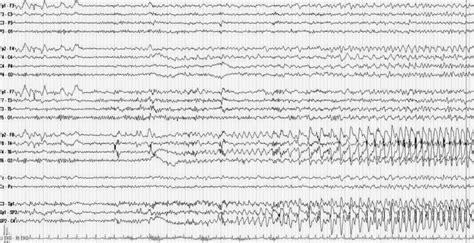 5 Eeg Recordings Of A Patient During Epileptic Seizure The Time