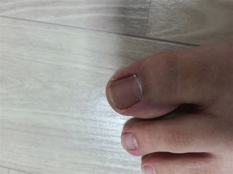 엄지 발톱의 검은 세로줄 지식in