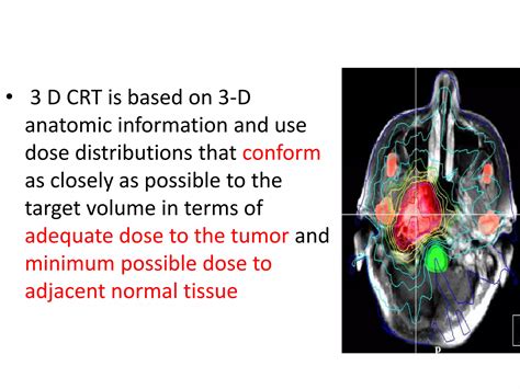 Three Dimensional Conformal Radiation Therapy Pptx