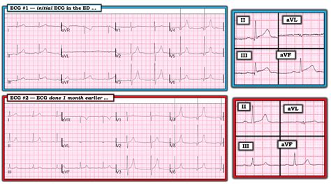 Dr Smiths Ecg Blog Inferior Subtle St Elevation Straight St Segment But Also No Reciprocal