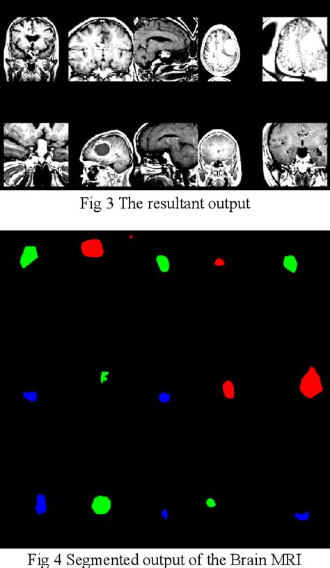Figure 4 From Brain Disease Detection Using Pspnet For Multiclass