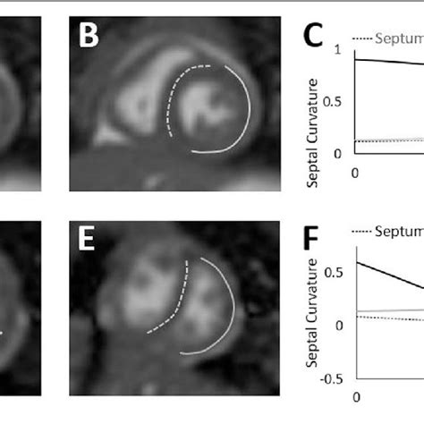 Cardiovascular Magnetic Resonance Cmr Eccentricity Index Ei And Download Scientific Diagram