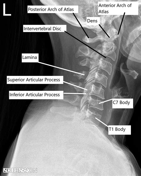 Posterior Cervical Fusion Complete Orthopedics And Podiatry