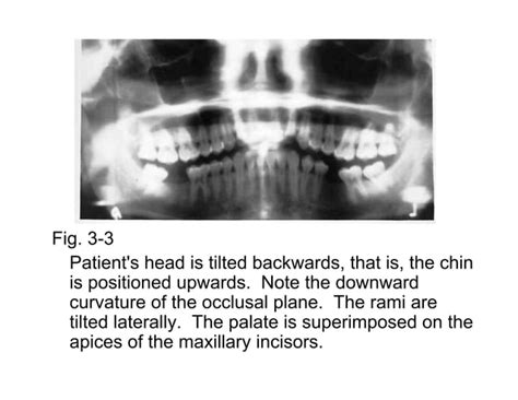 Positioning Errors In Panoramic Radiography PPT