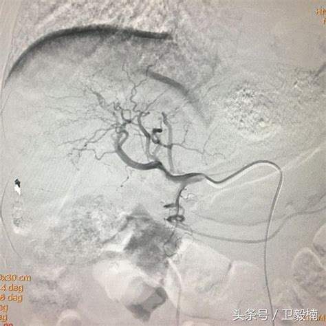 肝癌介入治療一運城市急救中心醫學影像科衛毅楠 每日頭條