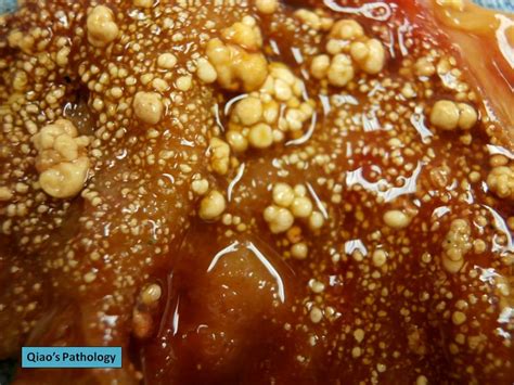 Flickriver Qiaos Pathology Art And Science In Medicine S Photos Tagged With Cholesterolosis