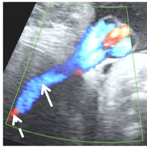 Summary Of Findings In The 12 Cases With Persistent Right Umbilical