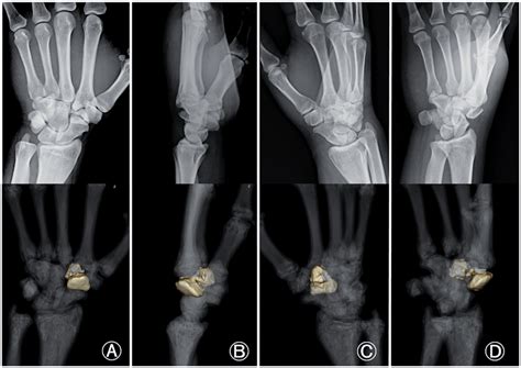 Comparison Between X Ray And Three Dimensional Computed Tomography 3 D Download Scientific